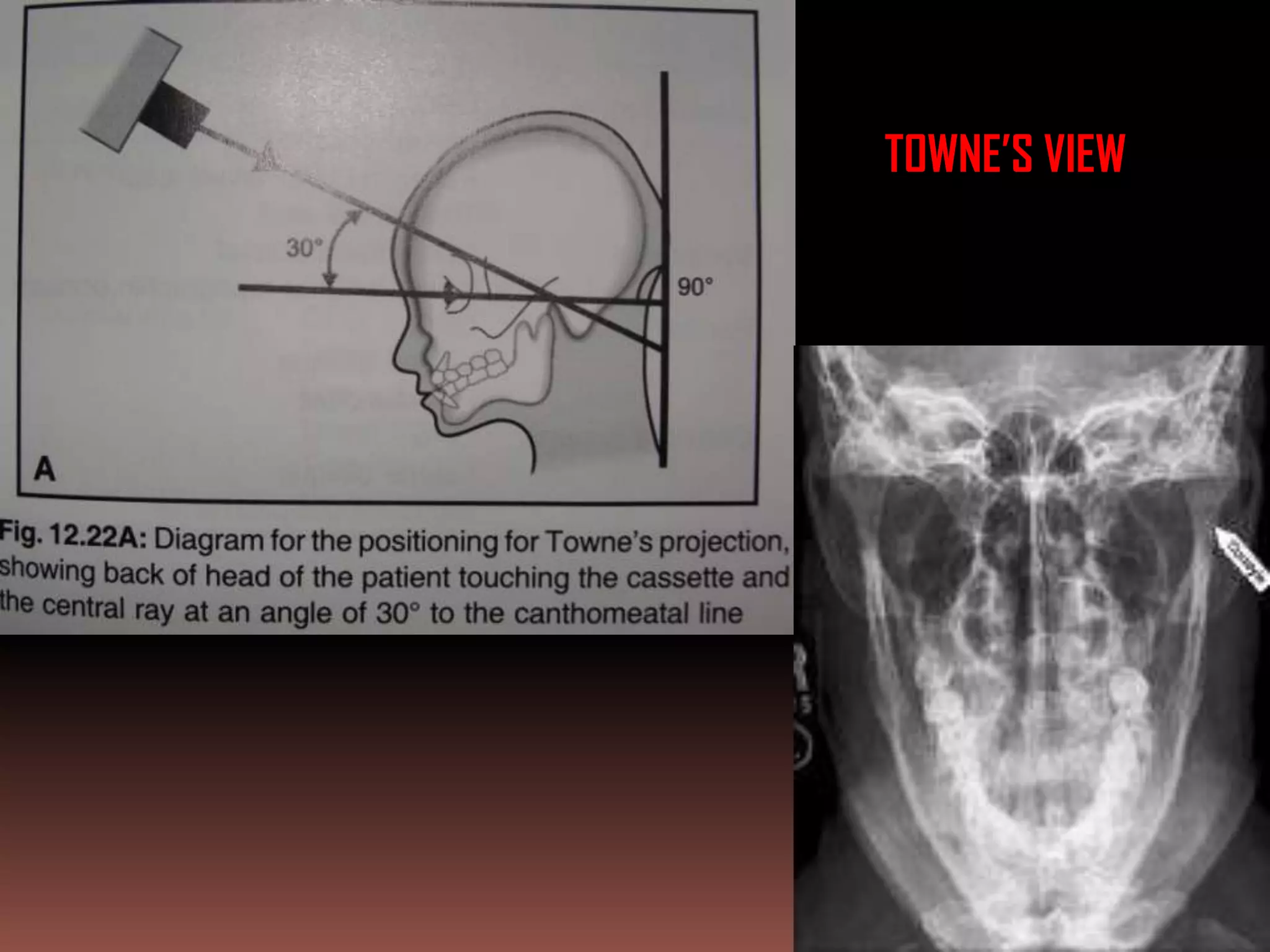 TMJ Imaging | PPTX | Bone and Joint Conditions | Diseases and Conditions