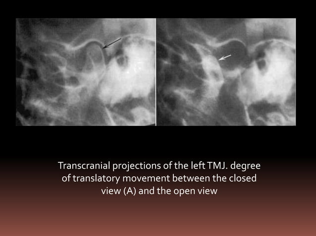 TMJ Imaging | PPTX | Bone and Joint Conditions | Diseases and Conditions