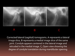 Tmj Lateral X Ray