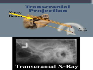 Tmj imaging techniques | PPTX