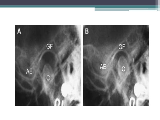 Tmj imaging techniques