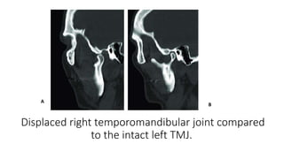 CT Temporomandibularjoints.pptx