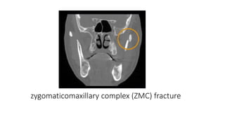 CT Temporomandibularjoints.pptx