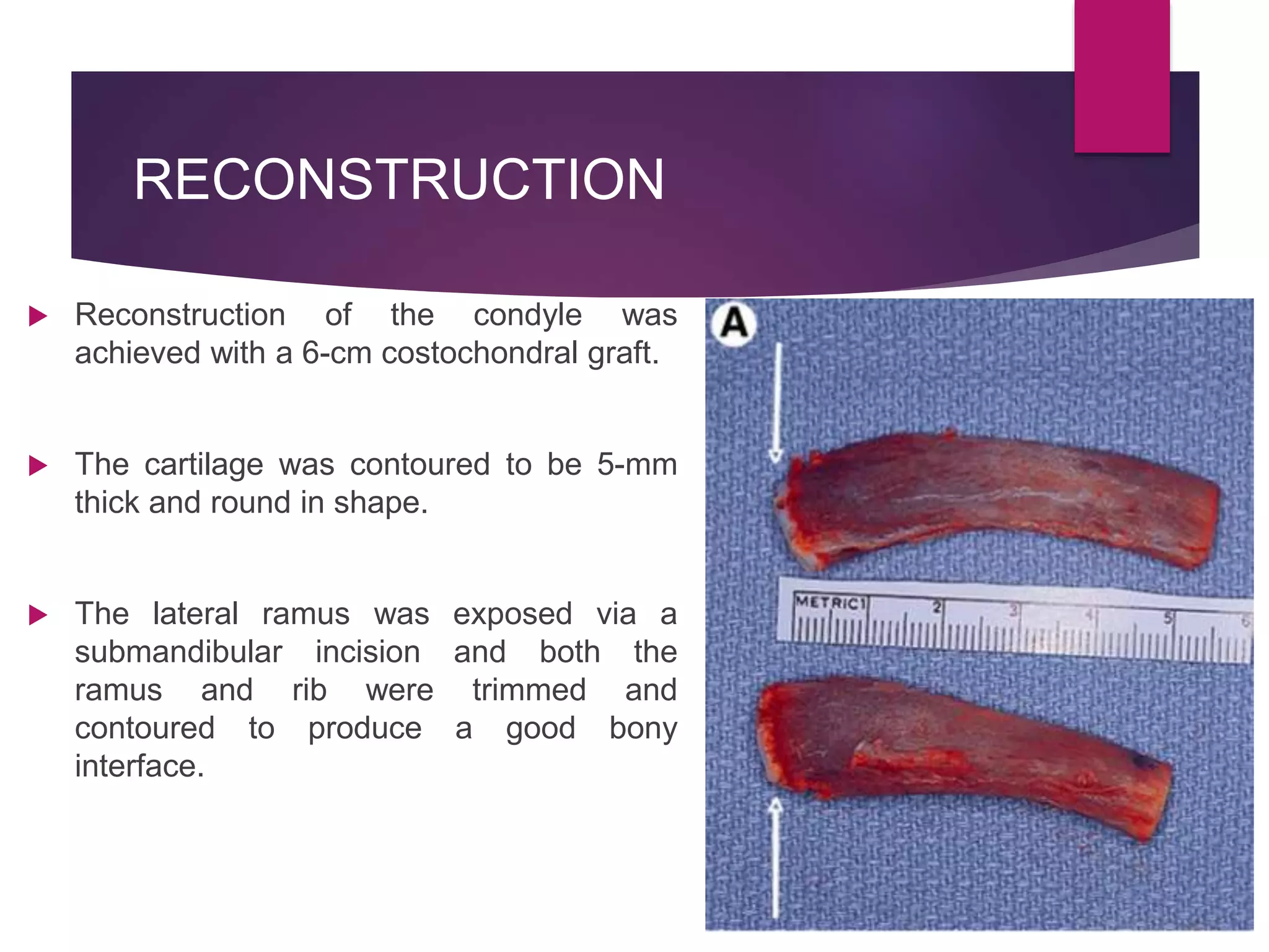 Kaban protocol tmj ankylosis treatment orignal 1990 | PPTX