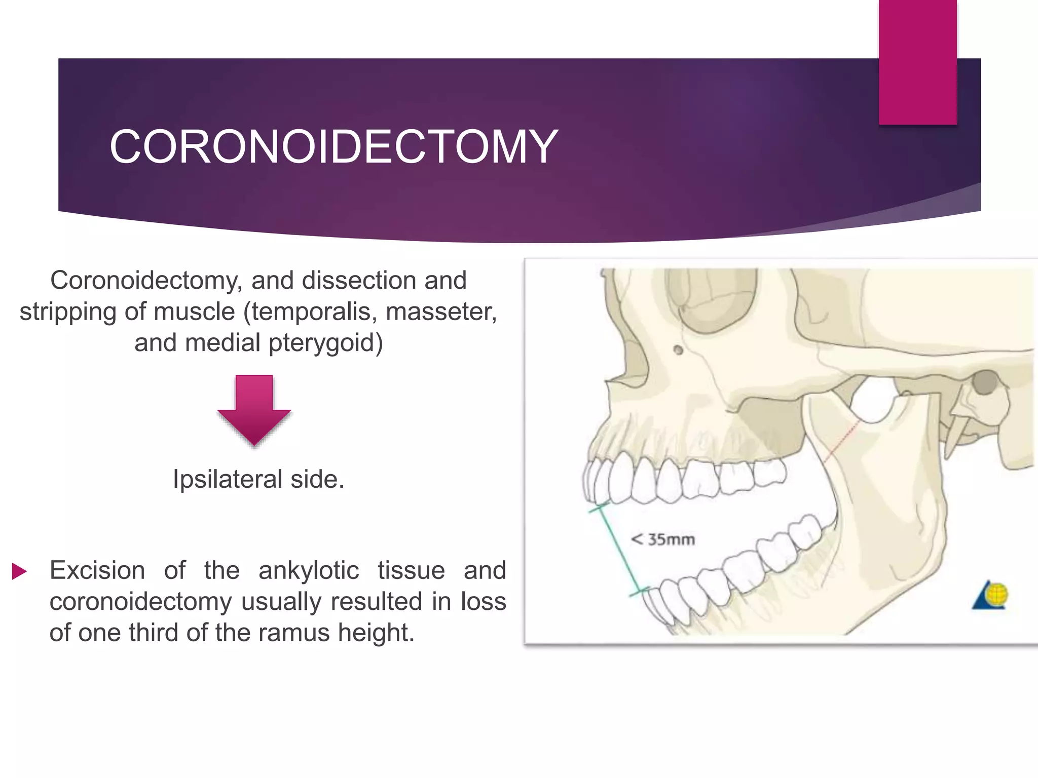 Kaban protocol tmj ankylosis treatment orignal 1990 | PPTX