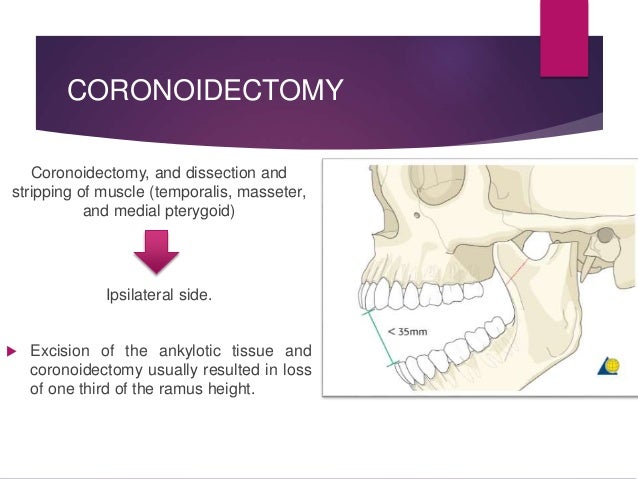 Kaban protocol tmj ankylosis treatment orignal 1990