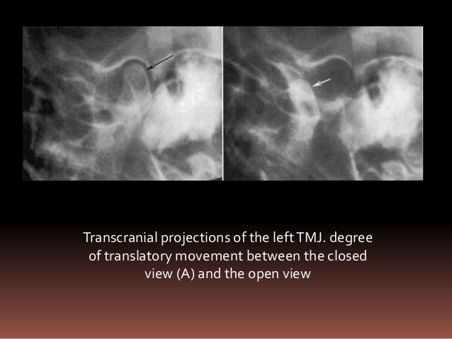 Tmj joint imaging
