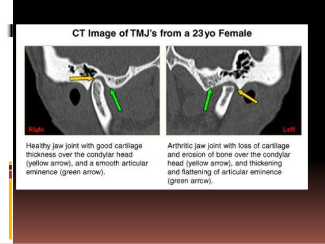 Tmj joint imaging
