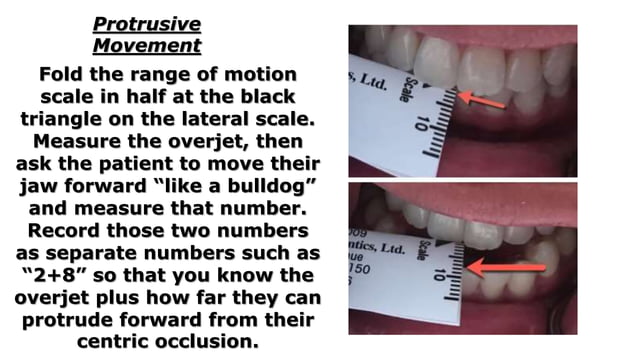 TMJ MOTION MEASUREMENTS | PPTX