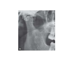 Tmj pathology | PPTX