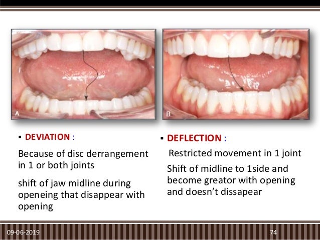 TMJ and Its Applied Aspects in Prosthodontics