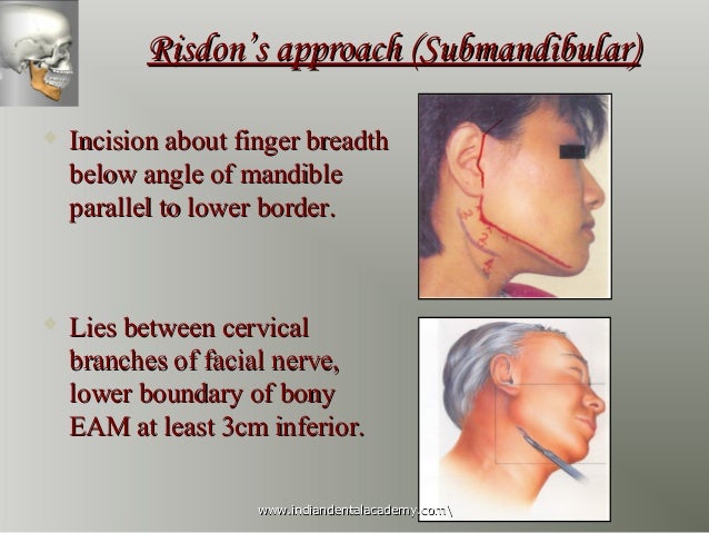 Tmj surgical anatomy and approaches (nx power lite) /certified fixed