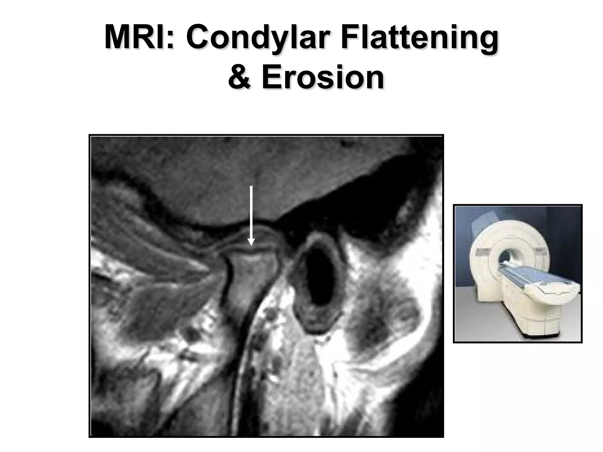 Temporomandibular Joint Arthritis in Pediatric Inflammatory ...