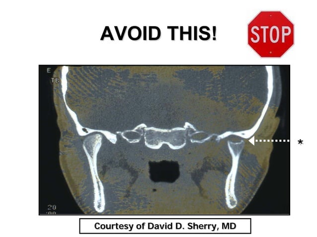 Temporomandibular Joint Arthritis in Pediatric Inflammatory ...