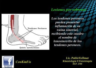 Tenosinovitis Músculos Peroneos | PDF