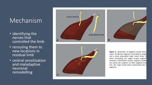 TMR in amputations | PPTX | Physical Therapy | Wellness