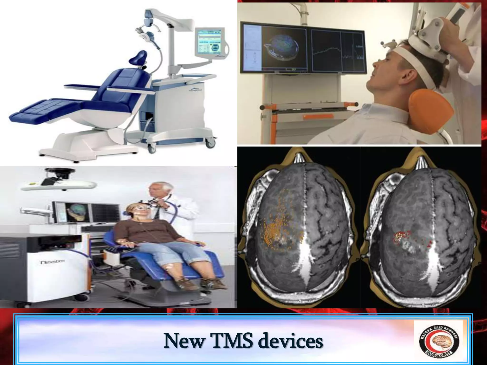 Transcranial Magnetic Stimulation | PPTX