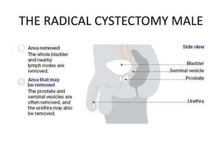 DEBATE IN CA BLADDER TMT VS CYSTECTOMY | PPTX