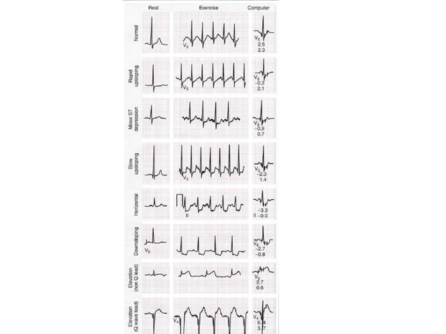 TMT is a test for heart regulation system | PDF | Heart and ...