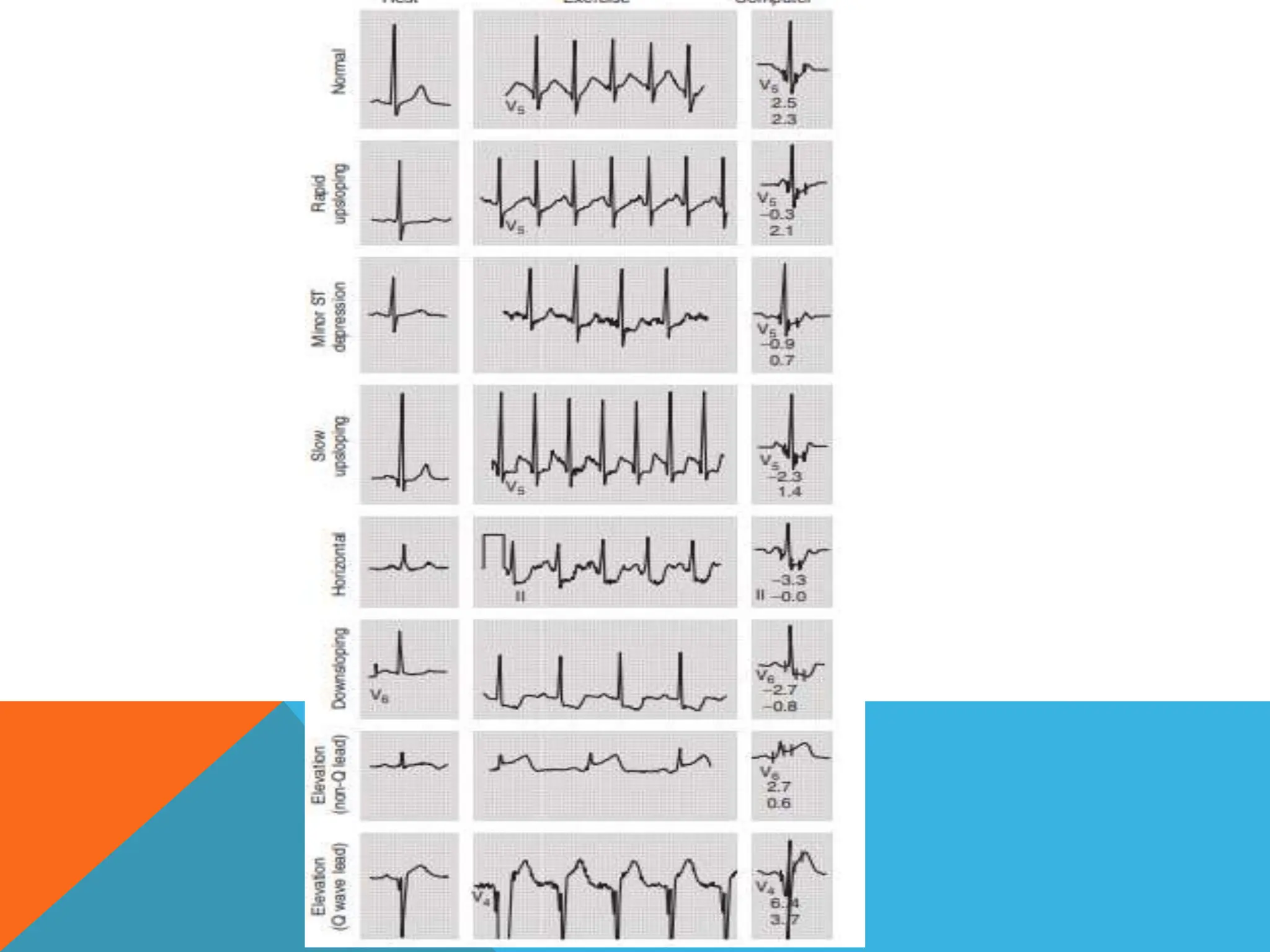 Treadmill stress testing | PPTX