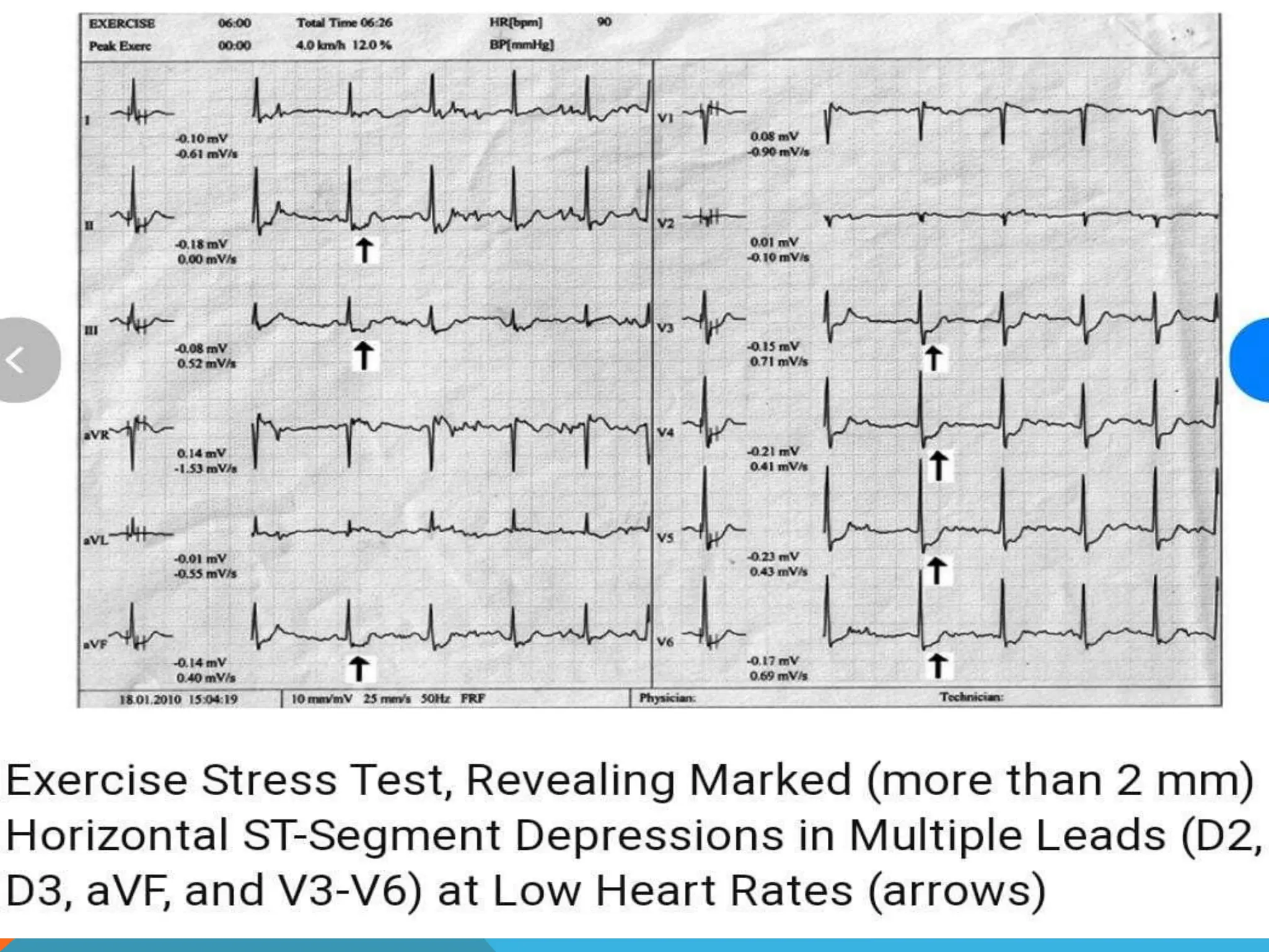 Treadmill stress testing | PPTX
