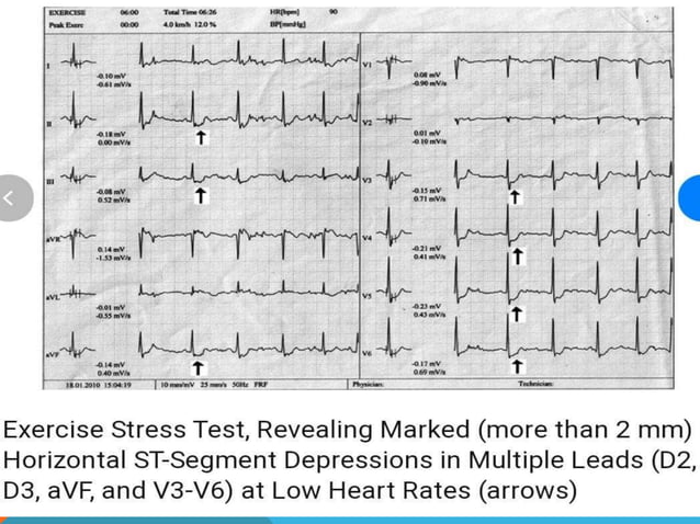Treadmill stress testing | PPTX