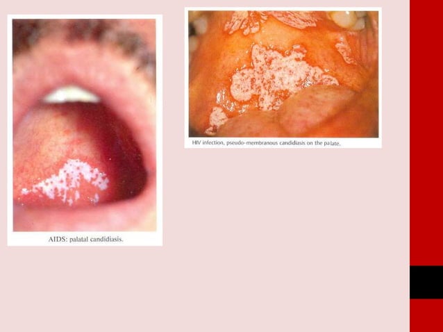 red and white lesions of oral cavity | PPTX