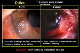 14 peri corn thin & ulcer | PPT
