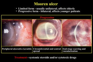 14 peri corn thin & ulcer | PPT