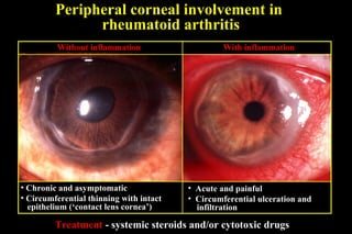 14 peri corn thin & ulcer | PPT