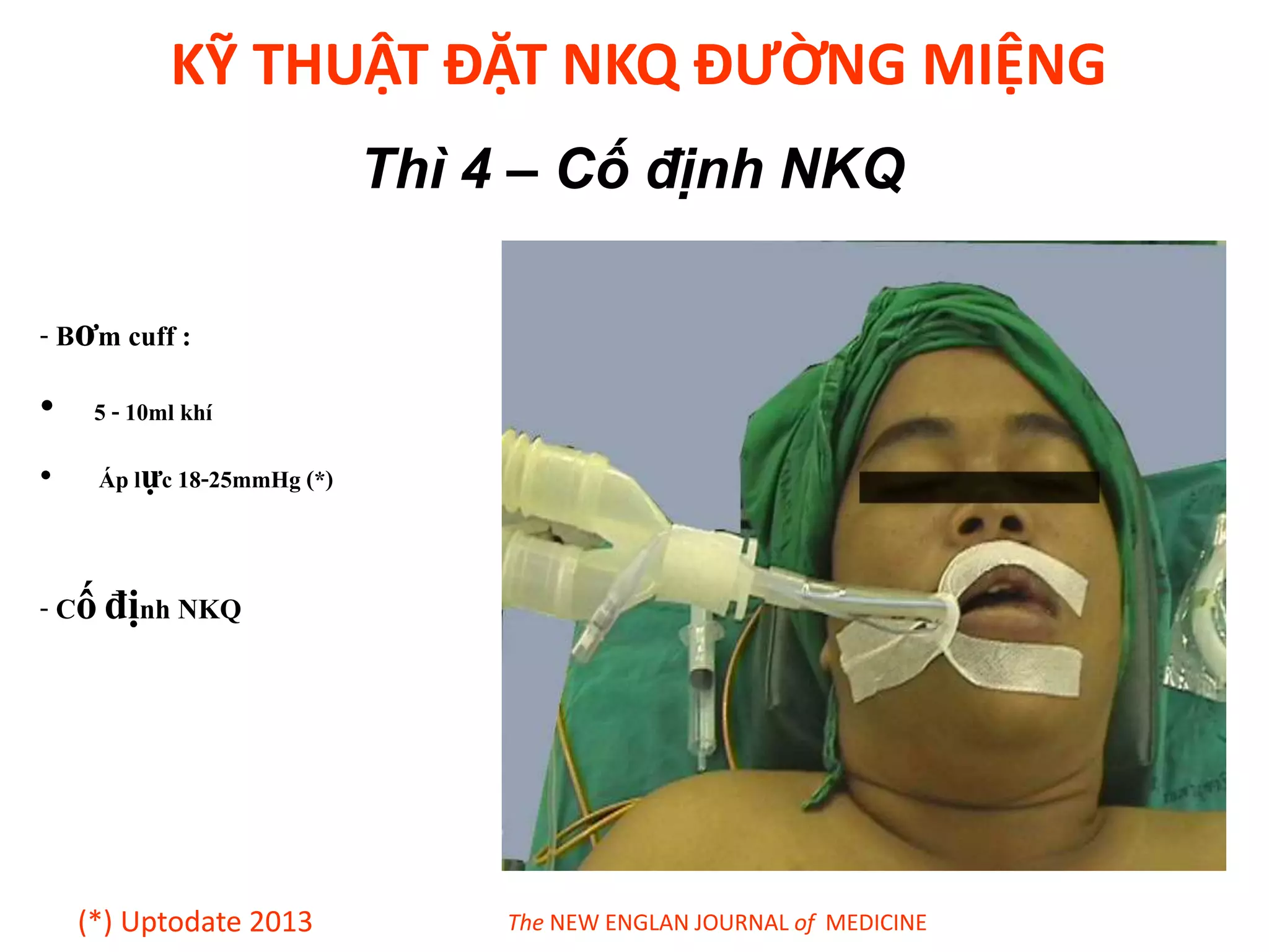 Đặt ống nội khí quản | PDF