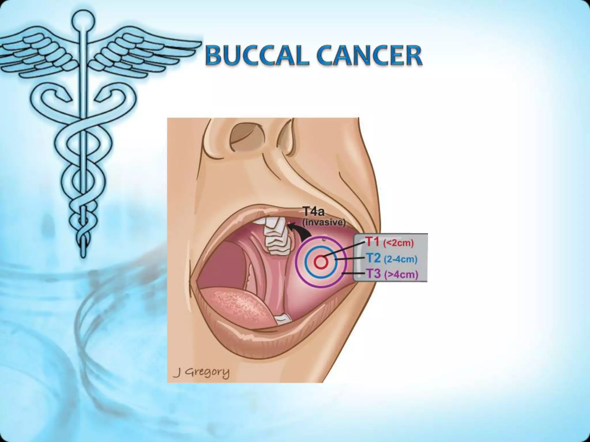 Tnm Staging Of Oral Cancer Ppt