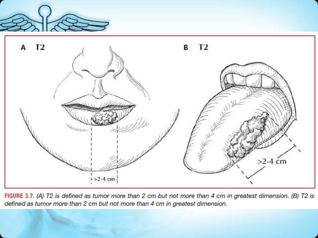 Tnm Staging Of Oral Cancer