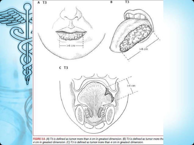 Tnm Staging Of Oral Cancer