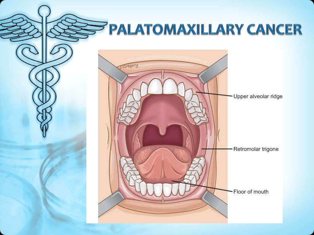 Tnm Staging Of Oral Cancer