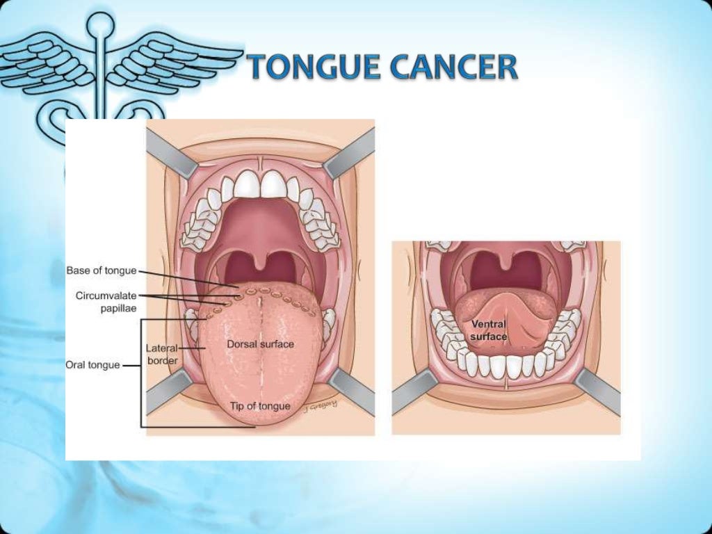 Tnm Staging Of Oral Cancer