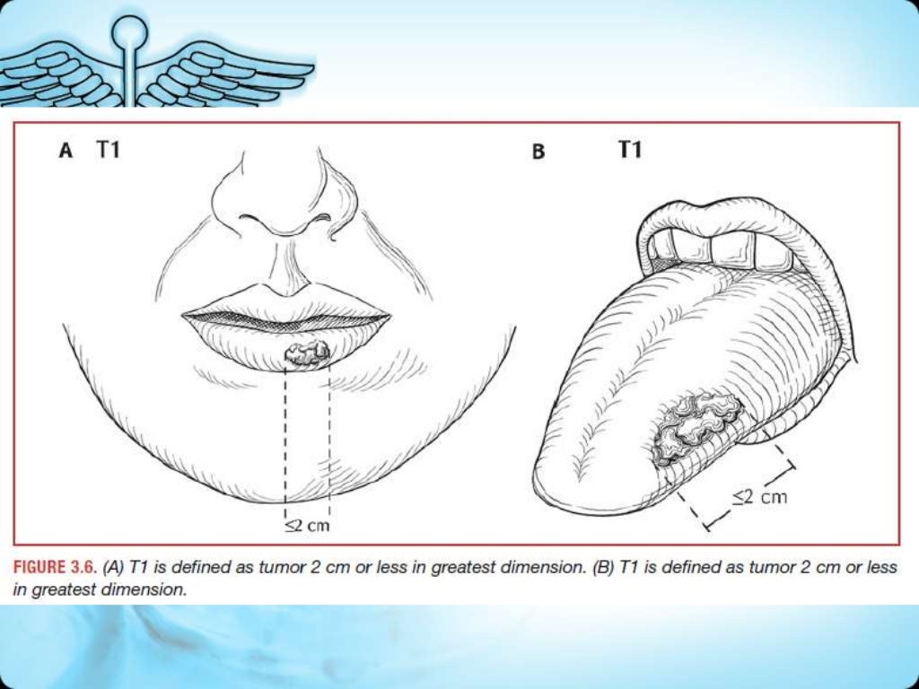 Tnm Staging Of Oral Cancer