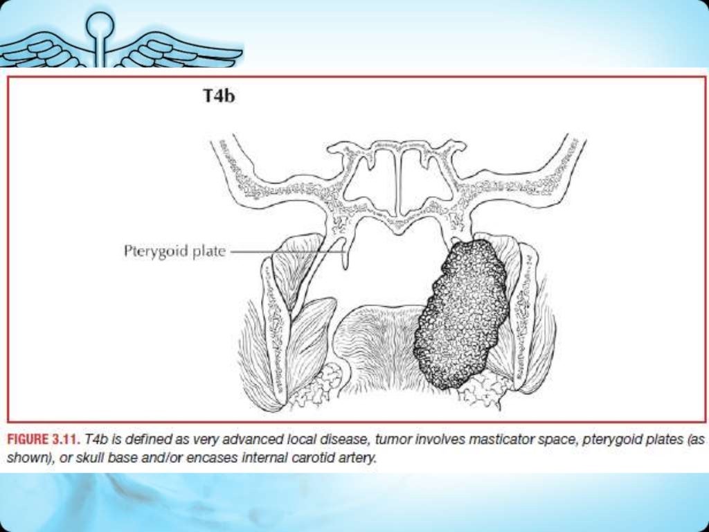 Tnm Staging Of Oral Cancer
