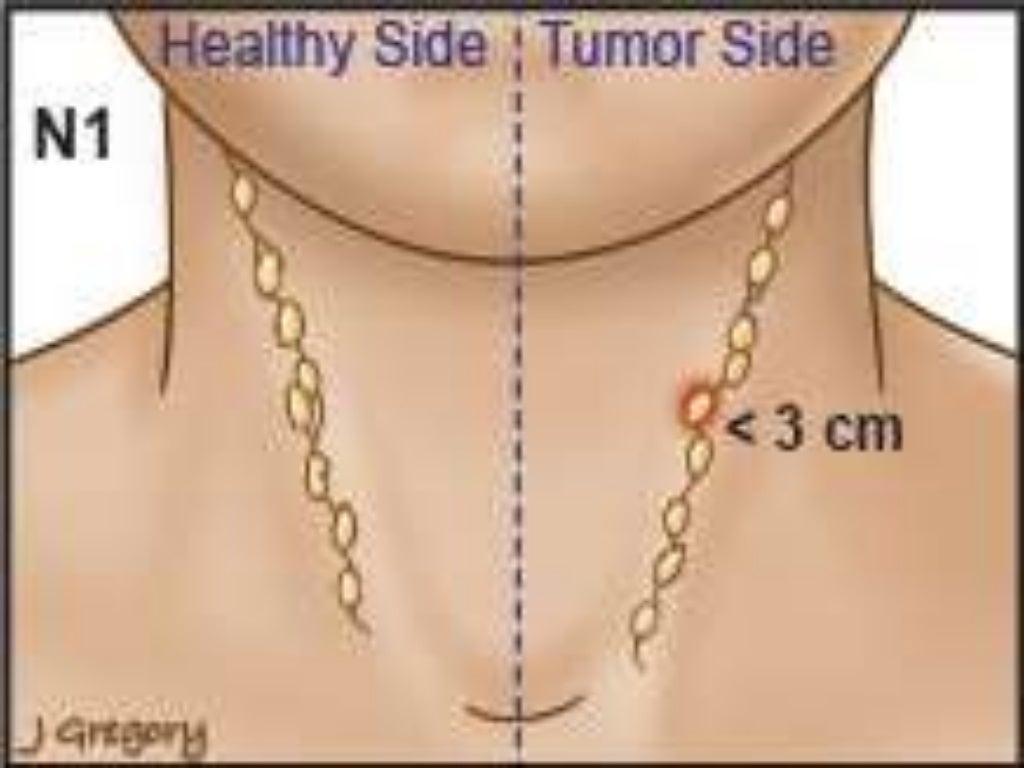 Tnm Staging Of Oral Cancer