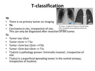 bronchogenic carcinoma TNM-8 edition | PPT