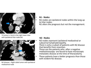 bronchogenic carcinoma TNM-8 edition | PPT