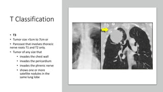 TNM lung presentation.pptx