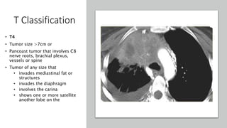 TNM lung presentation.pptx