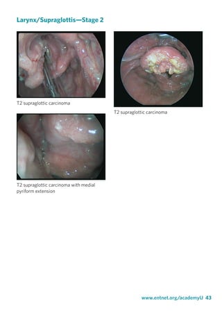 TNM staging of head neck cancer | PDF