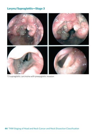 TNM staging of head neck cancer | PDF