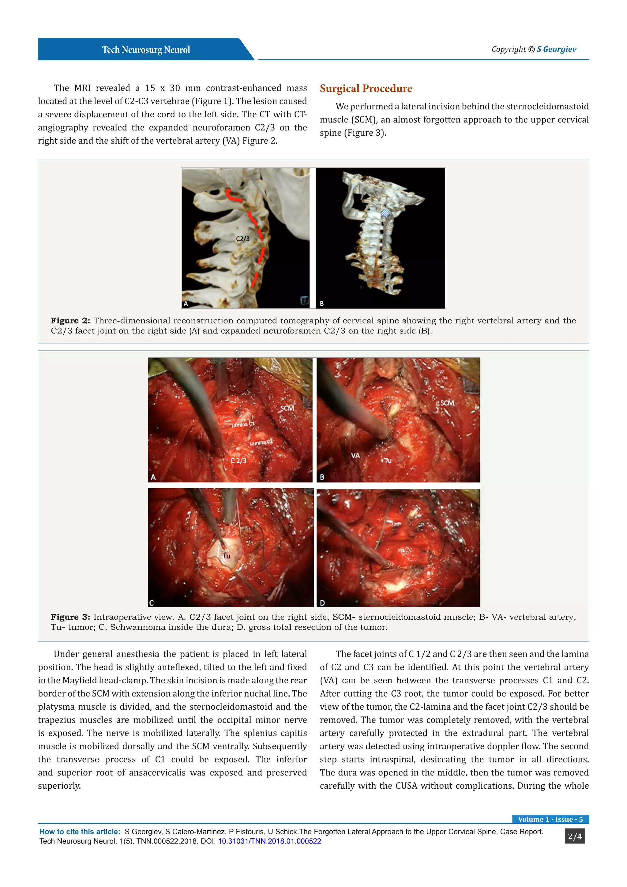 The Forgotten Lateral Approach to the Upper Cervical Spine, Case Report ...