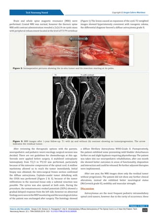 Intramedullary Diffuse Astrocytoma of The Spinal Cord in a 3-Year-Old ...