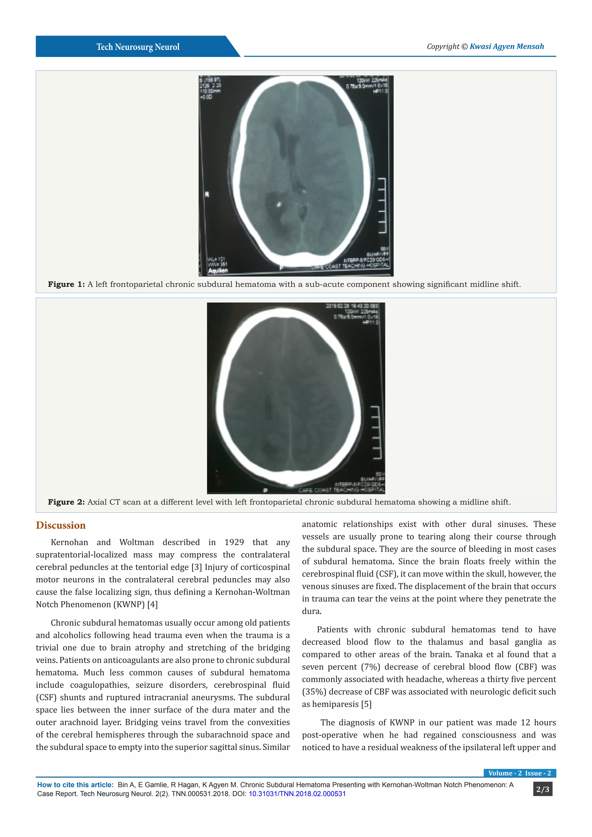 Chronic Subdural Hematoma Presenting With Kernohan Woltman Notch