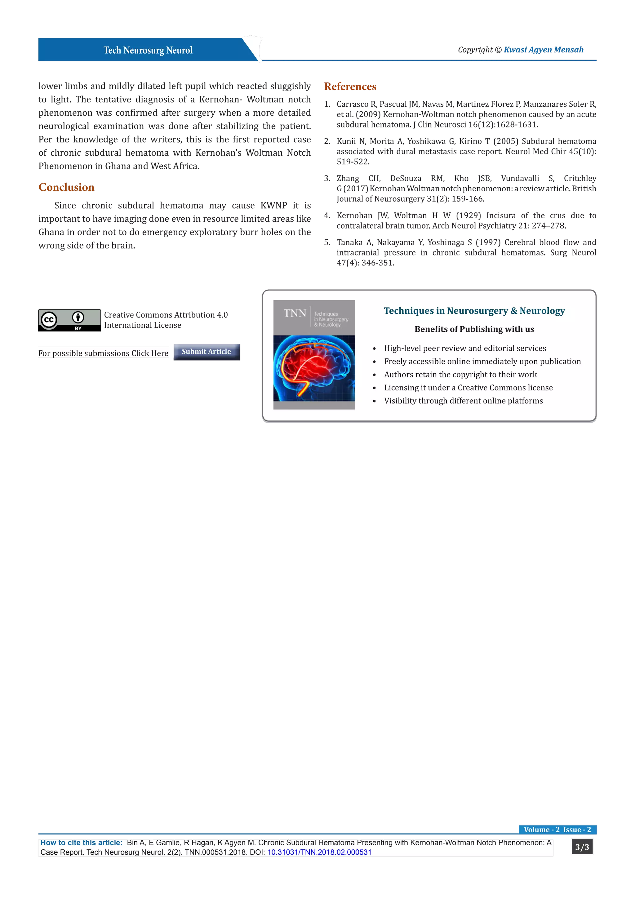 Chronic Subdural Hematoma Presenting With Kernohan Woltman Notch