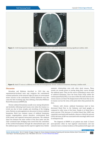 Chronic Subdural Hematoma Presenting with Kernohan-Woltman Notch Phenomenon: A Case Report ...